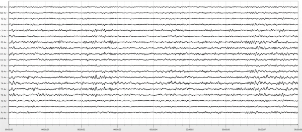 QEEG (Quantitative Electroencephalogram) - 0405971958