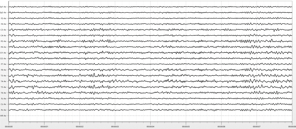 QEEG (Quantitative Electroencephalogram) - 0405971958